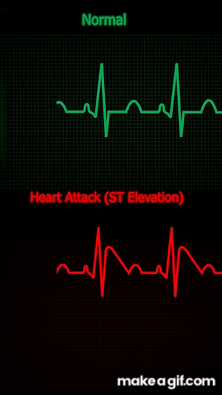 ECG Normal vs Heart Attack ST Elevation How to Read ECG in Simple Steps ...