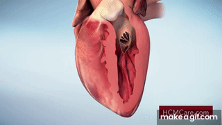 Hypertrophic Cardiomyopathy (HCM) Mechanism of Disease Video on Make a GIF
