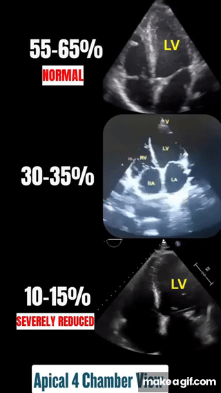 Normal to Severely Reduced Ejection Fraction on Echo | 4 Chambers view ...