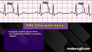 PVCs vs PACs vs PJCs Rhythms ECG Interpretation Compilation Nursing ...