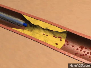 Stent Animation on Make a GIF