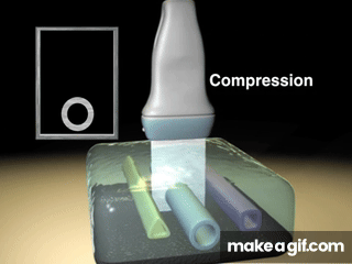 Ultrasound Transducer Manipulation on Make a GIF