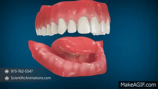 Dental Surgery - SubPeriostial Implant for Bone Loss in the Jaw on Make ...