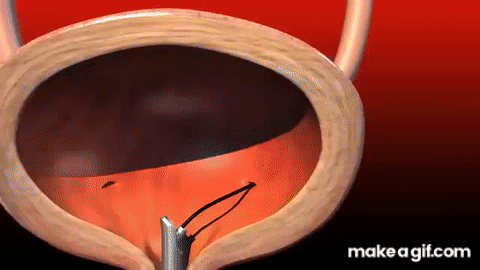 Ureteral Obstruction - Retrograde insertion of Resonance stent on Make ...