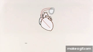 ICDs Explained Ask the ICD on Make a GIF