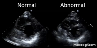 Echocardiogram from the Patient Compared with That from a Normal ...