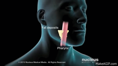 Obstructive Sleep Apnea on Make a GIF