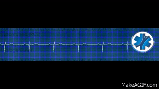 Ritmos de Paro FV-TVSP-AESP-ASISTOLIA on Make a GIF