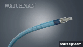 WATCHMAN™ Left Atrial Appendage Closure Device - Treatment Animation on ...