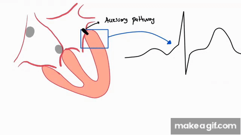 Accessory pathway on Make a GIF