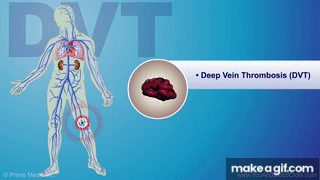 Understanding and Diagnosing Venous Thromboembolism (VTE) on Make a GIF