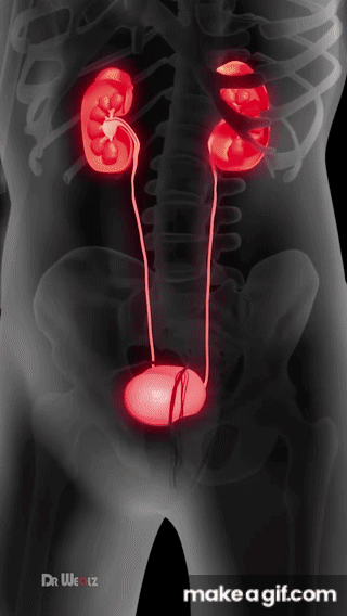 What Could Cause Kidney Stones (Animation) on Make a GIF