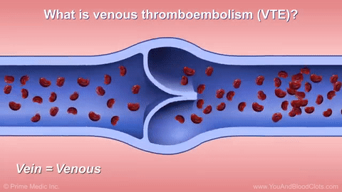 Understanding and Diagnosing Venous Thromboembolism (VTE) on Make a GIF