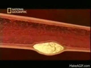 infarto agudo do miocárdio on Make a GIF