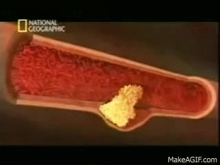 infarto agudo do miocárdio on Make a GIF