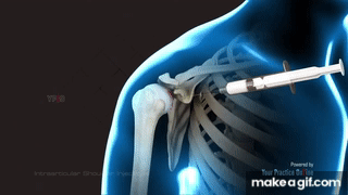 Intraarticular Shoulder Injection on Make a GIF