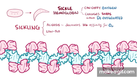 Sickle cell anemia - causes, symptoms, diagnosis, treatment & pathology ...