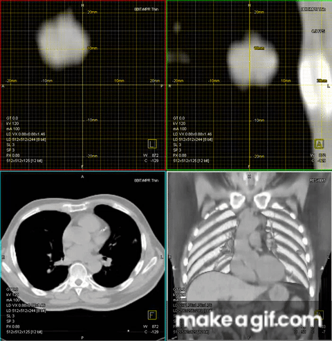 Moving lung tumor during imaging (radiation therapy) on Make a GIF