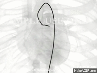 Patient Education Video: Coronary Artery Angioplasty on Make a GIF
