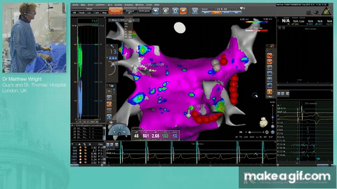 Efficient AF Ablation Workflow With CARTO®3 System And Ablation Index ...