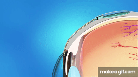 Glaucoma Implant Surgery on Make a GIF