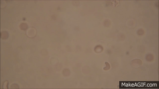 Red blood cells under the microscope, hypo and hypertonic solutions on ...