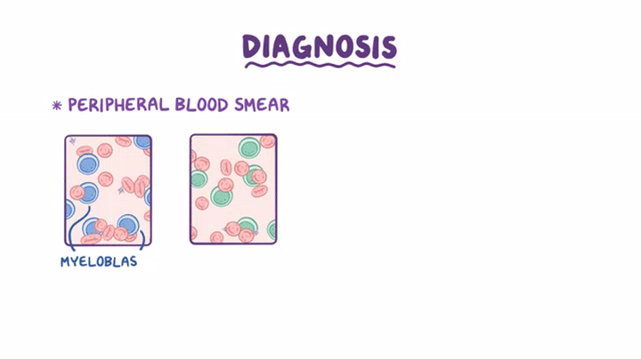 Acute myeloid & lymphoblastic leukemia - causes, symptoms & pathology ...