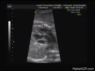 TGA Transposition of great arteries on Make a GIF