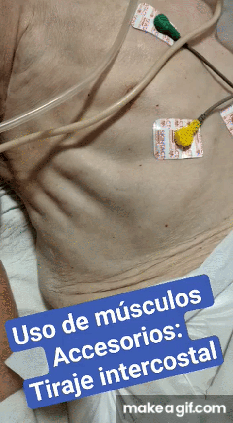 Uso de Músculos Accesorios: Tiraje intercostal on Make a GIF