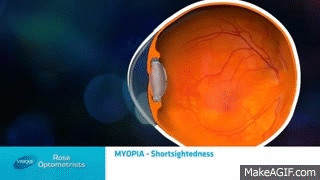 Short-sightedness - What is it? - Rose Optometrists explain on Make a GIF