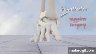 Ankle Fracture Classification on Make a GIF