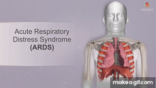 Acute respiratory distress syndrome ( ARDS ) Etiology, Clinical ...