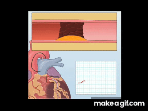NEJM Procedure: Primary PCI for Myocardial Infarction with ST-Segmented ...