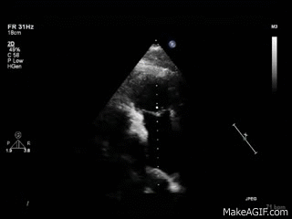 17. Measurement of acceleration time (for mPAP) at right ventricular ...