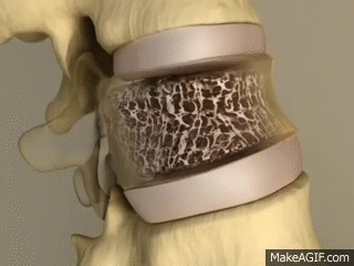 PML0904-AA Osteoporosis Video.wmv on Make a GIF