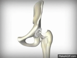 Hip replacement gif on Make a GIF