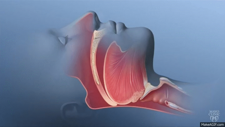 Obesity Hypoventilation Syndrome - Mayo Clinic on Make a GIF