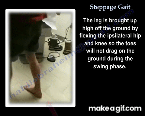 Slap gait , Steppage Gait . Foot Drop - Everything You Need To Know ...