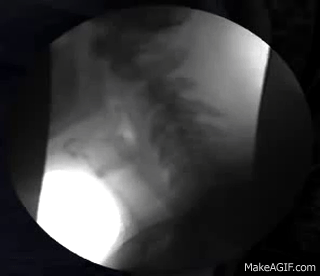 Intra swallow aspiration on Make a GIF