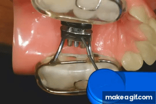 How to turn an RPE (Rapid Palatal Expander) : Nirenblatt Orthodontics ...