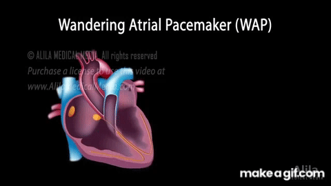 Wandering Atrial Pacemaker (WAP) & Multifocal Atrial Tachycardia (MAT ...