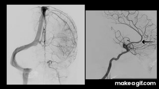 cerebral angiogram - Session 1 on Make a GIF