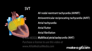 Supraventricular Tachycardia (SVT, PSVT), Animation on Make a GIF
