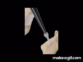Prótesis de cadera cementada on Make a GIF