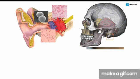 Mastoiditis (& Acute Otitis Media) | Causes, Pathophysiology, Symptoms ...