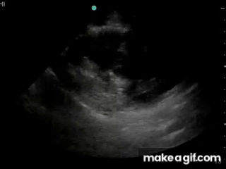 DOA 12 year old with Heart Transplant Cardiac Standstill on Make a GIF