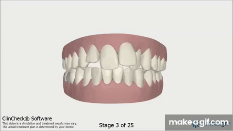 3D Treatment Plan on Make a GIF