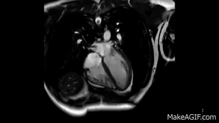 Cardiac MRI scan shows a heartbeat in high resolution on Make a GIF