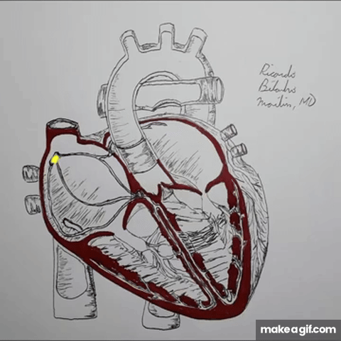 Mobitz II 2nd Degree Heart Block - Animation and ECG on Make a GIF