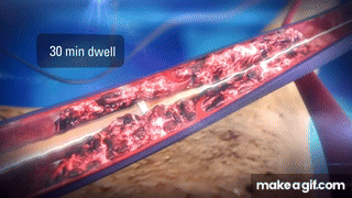 AngioJet™ Peripheral Thrombectomy System Boston Scientific on Make a GIF